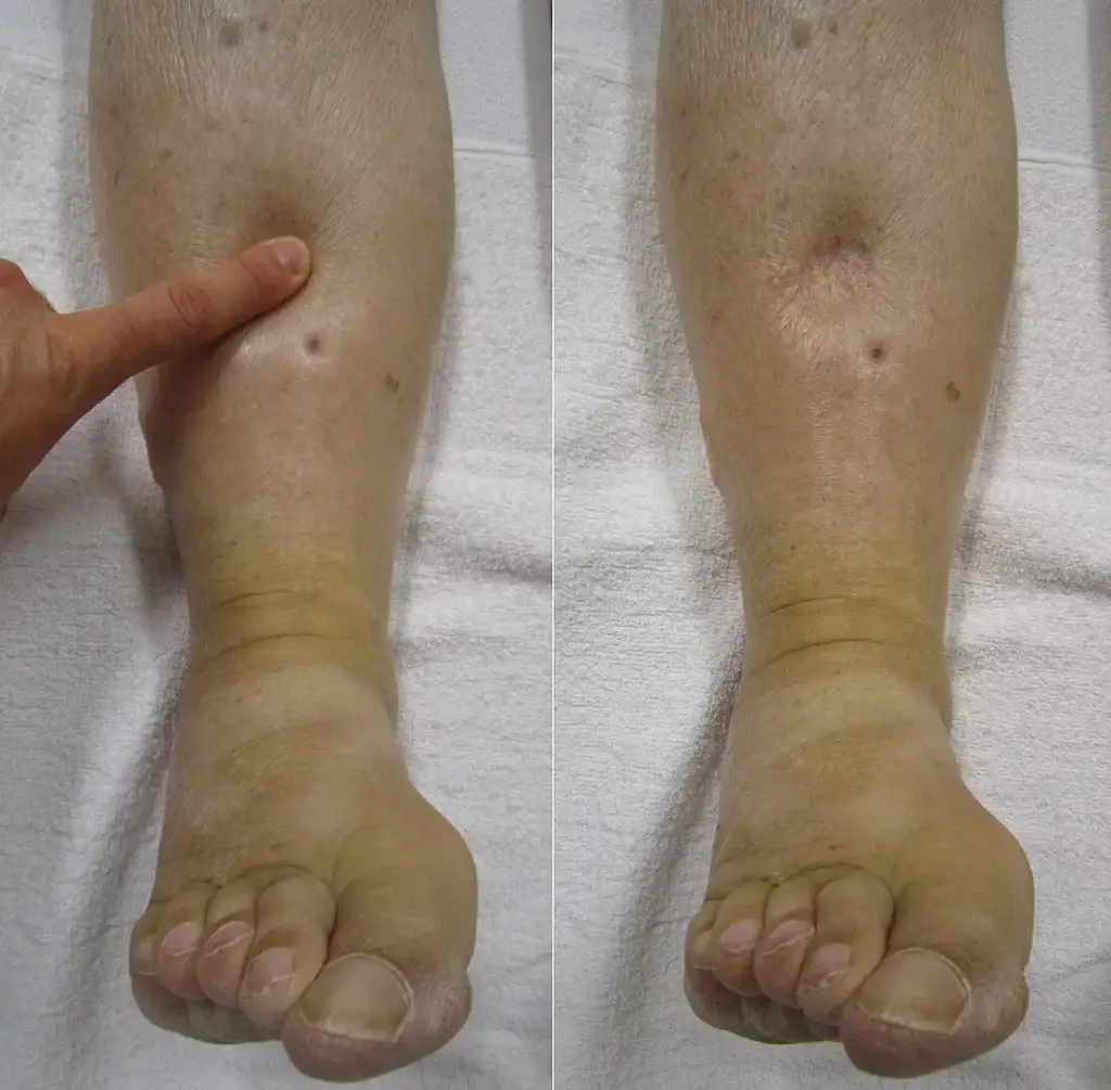 Postpartum swelling (edema) - Baby Kids Health