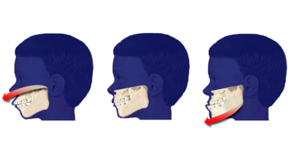 Ultra-Processed Foods Harm Children's Jaw Development - Baby Kids Health